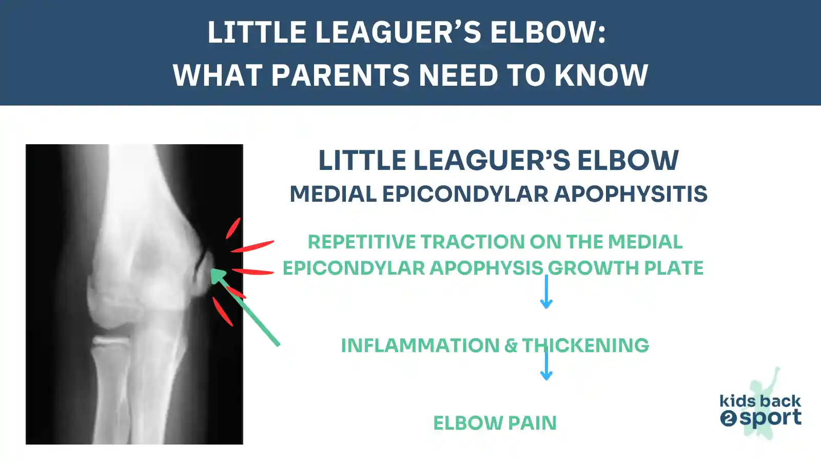 Little Leaguer’s Elbow: What Parents Need to Know | Kids Back 2 Sport